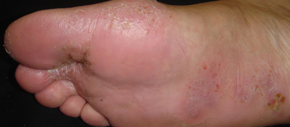 Disidrose: o que é e como tratá-la